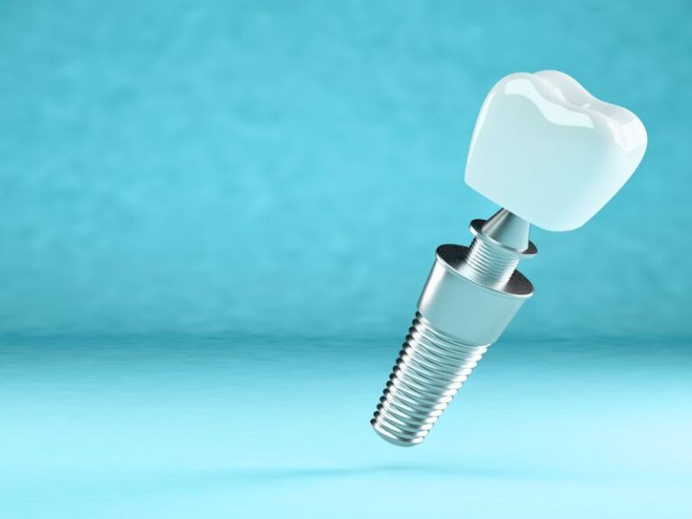 O Passo a Passo da Prótese sobre Implante: Guia Completo – ZR Odonto